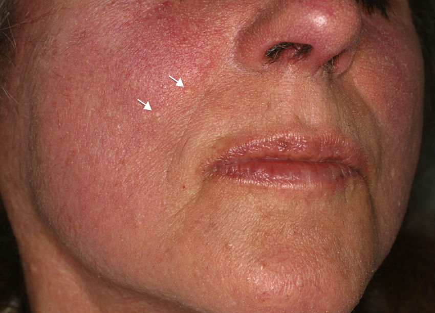 papules on face