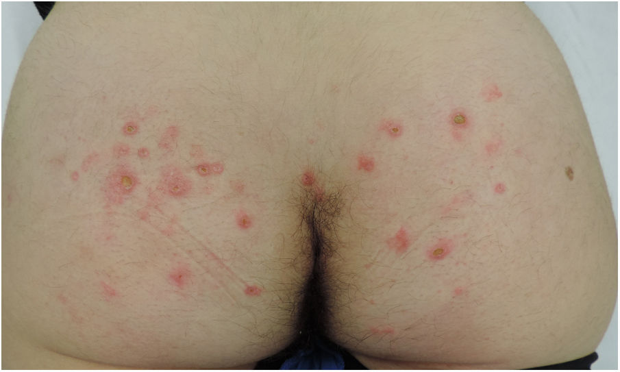 hookworm larvae rash
