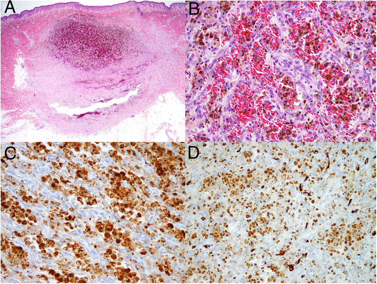 Lower Back Nodule in a Young Woman | Actas Dermo-Sifiliográficas