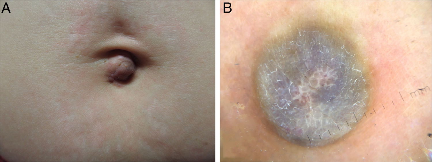 Villar Nodule: An Umbilical Nodule Associated With a Good Prognosis ...