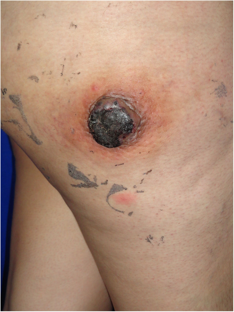 ewing sarcoma solid tumor