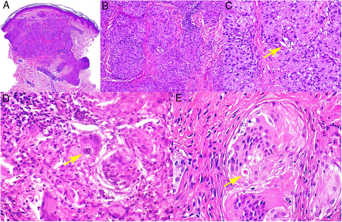 scrofuloderma pathology