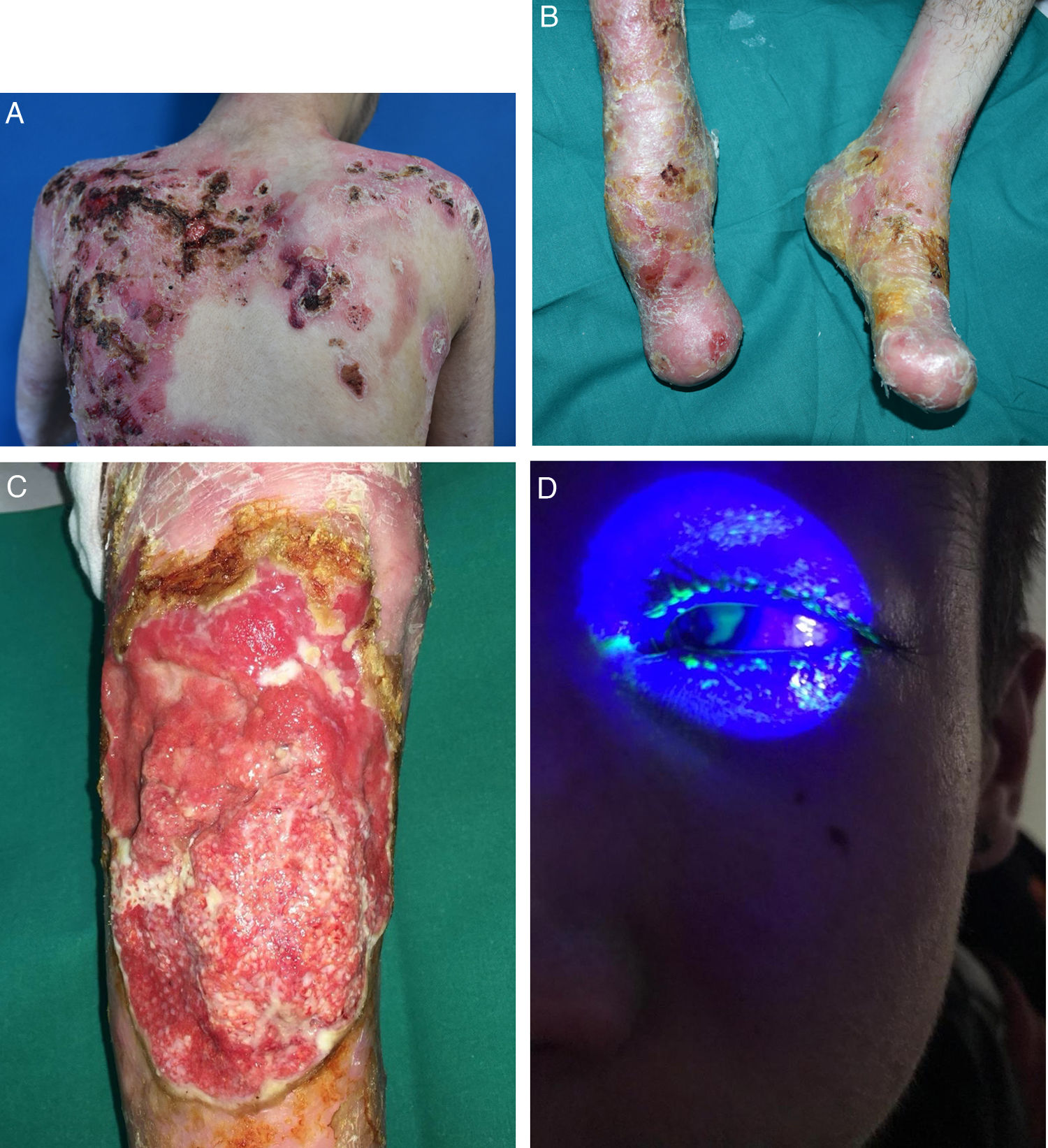 dystrophic epidermolysis bullosa life expectancy