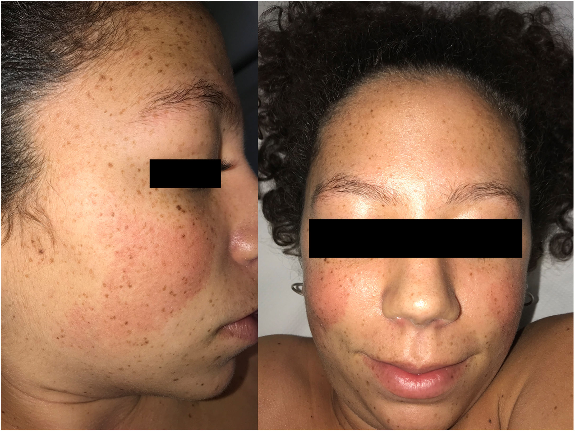 multiple lentiginosis