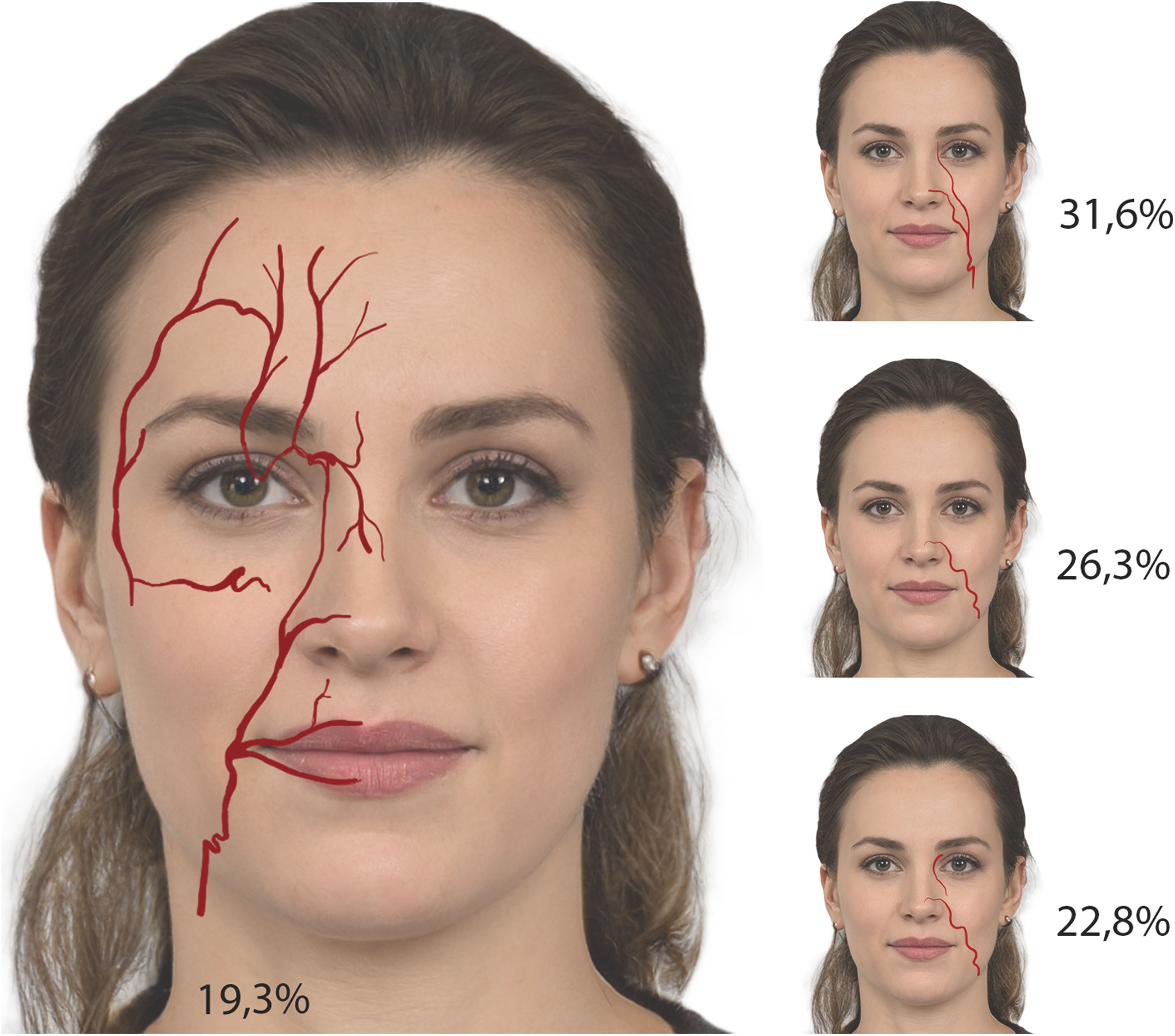 Safety in Dermatologic Procedures: Vascular Occlusion by Filling ...