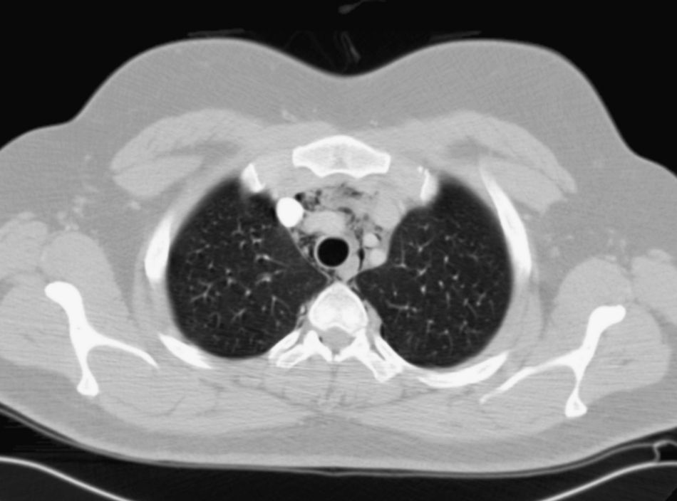 Spontaneous Pneumomediastinum and Pneumopericardium with Respiratory ...