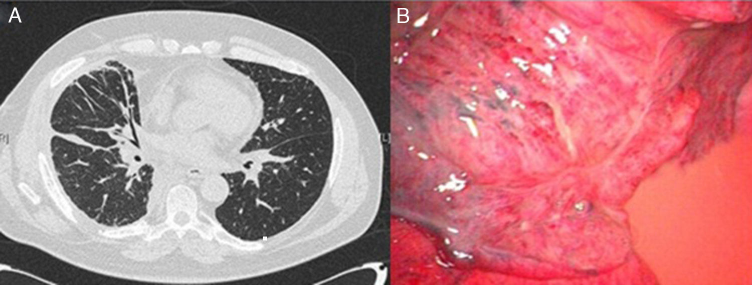 pulmonary lymphangitis