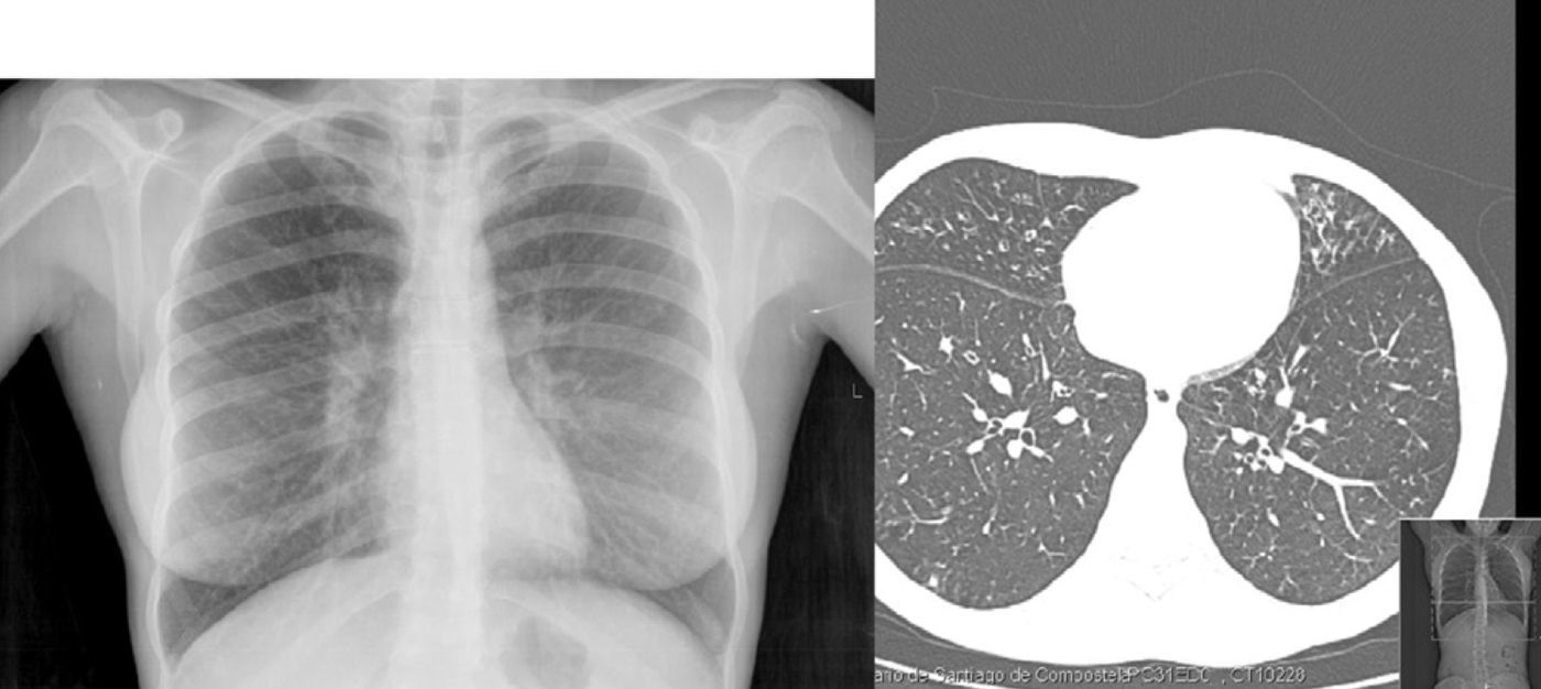 Pandoraea Sputorum Colonization in a Patient With Cystic Fibrosis ...