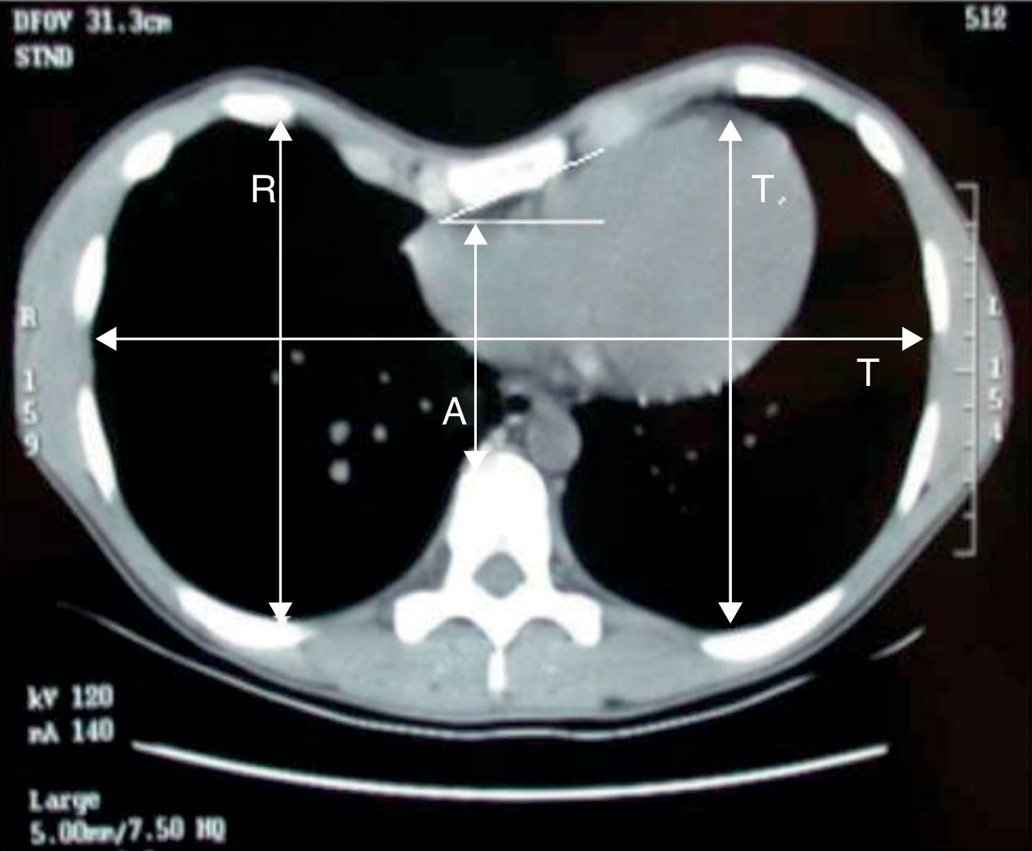 Dysmorphology of Chest Wall Deformities: Frequency Distribution of ...