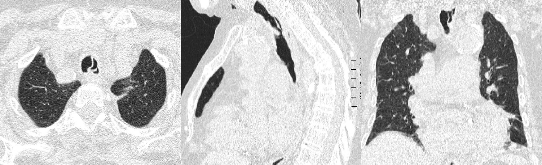 Obstructive Inflammatory Tracheal Pseudomembrane | Archivos de ...