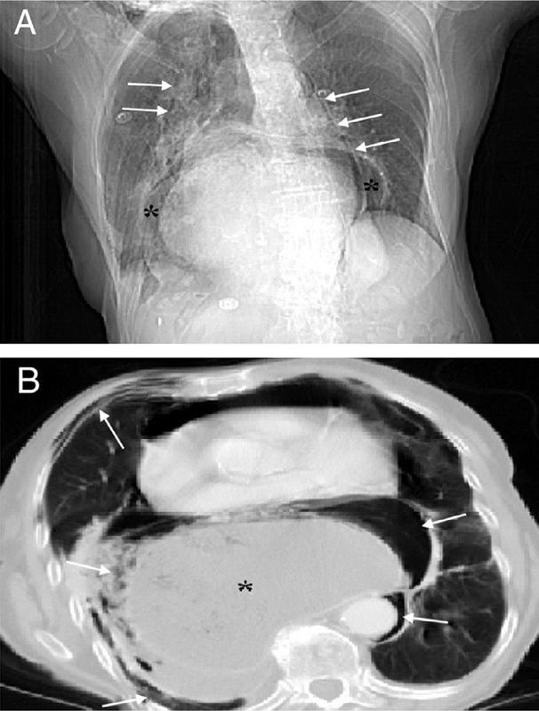 Hydropneumomediastinum Secondary to Gastric Volvulus Perforation in a ...
