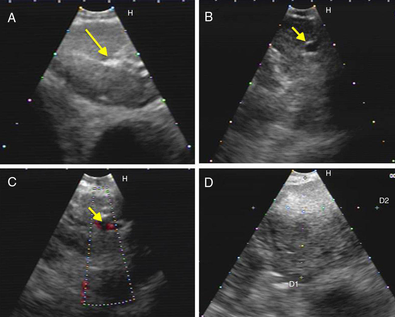 mediastinal lymph nodes