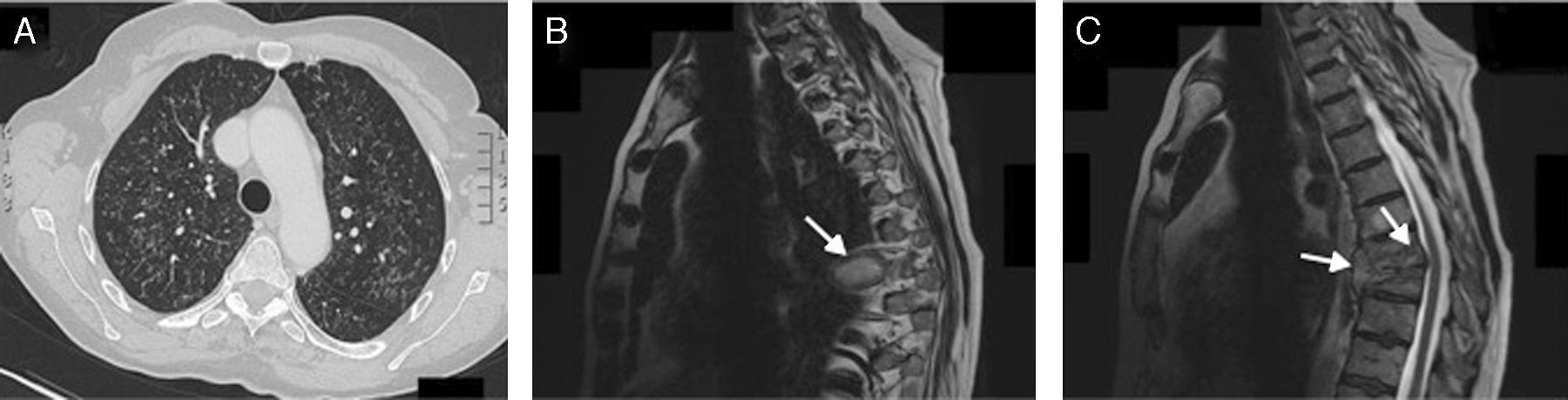 miliary tuberculosis ct