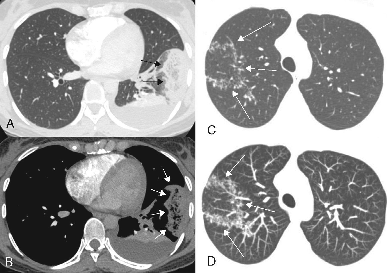 Reversed Halo Sign: Criteria for Narrowing the Differential Diagnosis ...