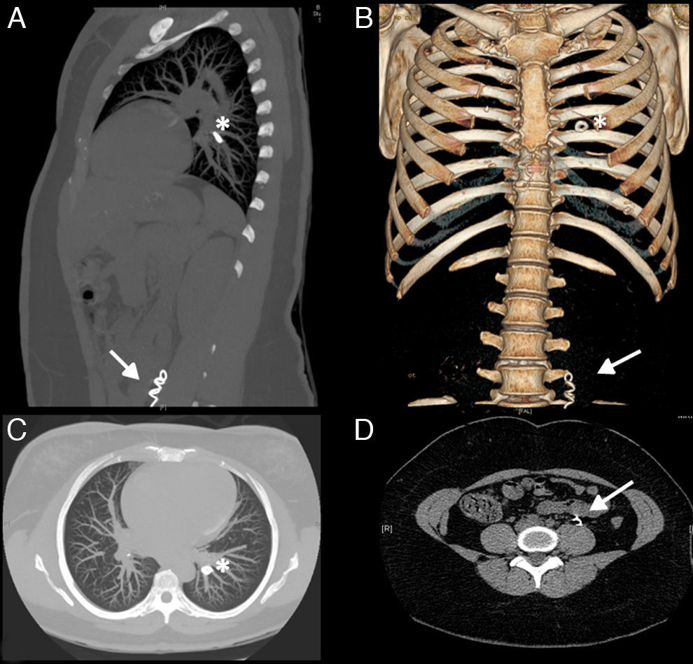 pelvic vein embolization
