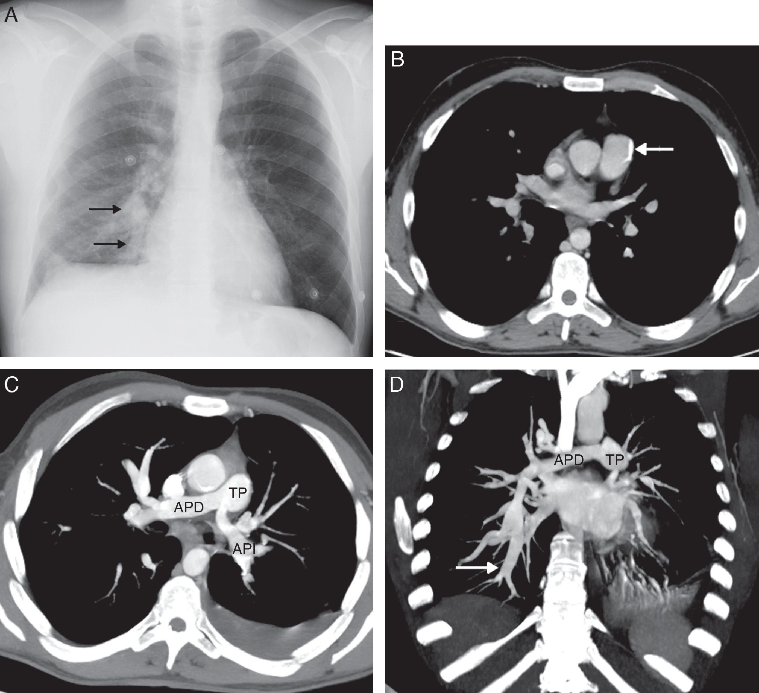 pulmonary trunk ct