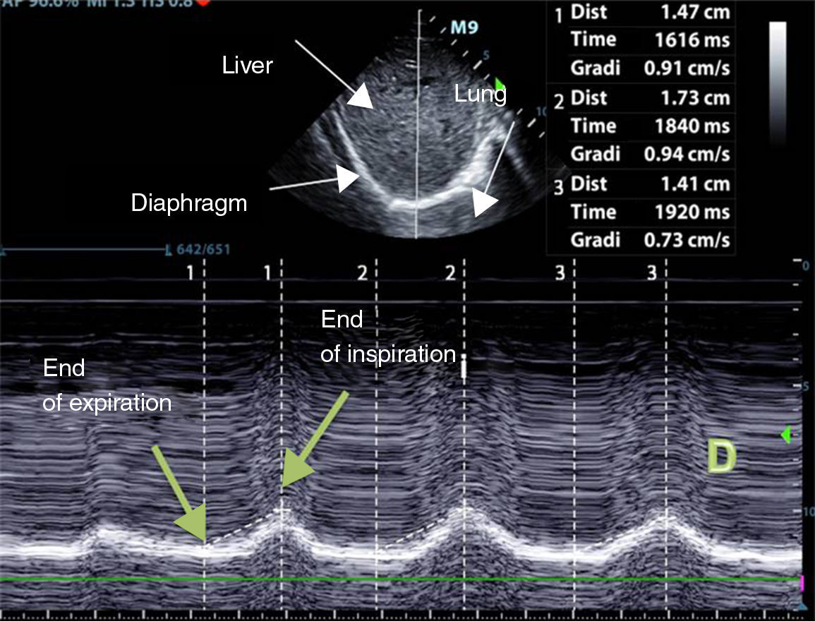 define diaphragmatic excursion