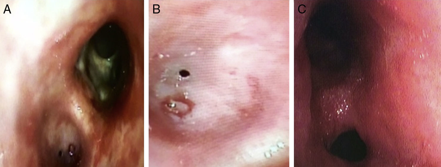 bronchoscopy pneumonia