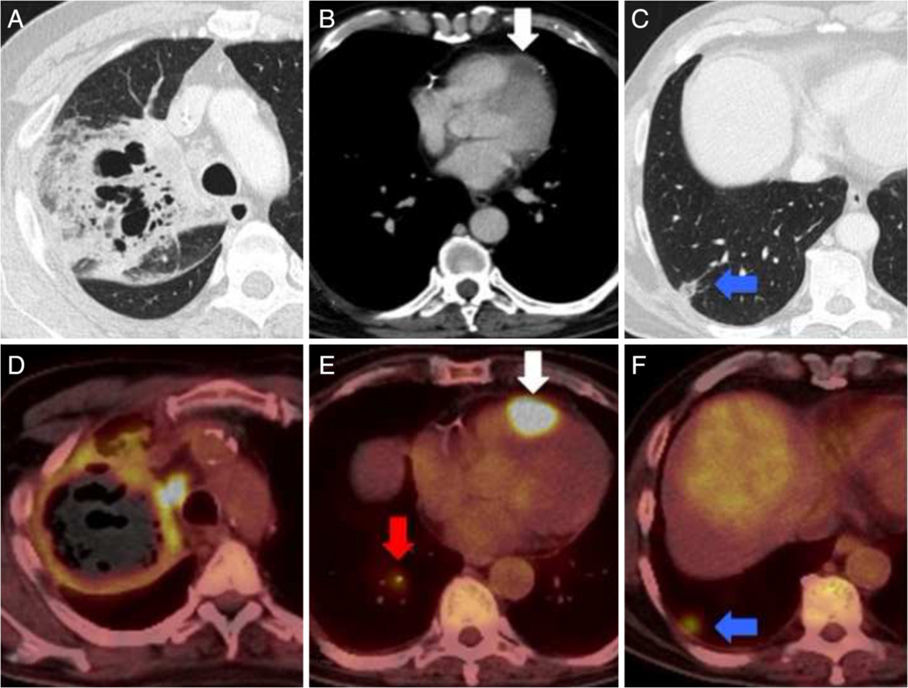Pulmonary Tumor Embolism due to Cardiac Metastasis of Lung Cancer ...