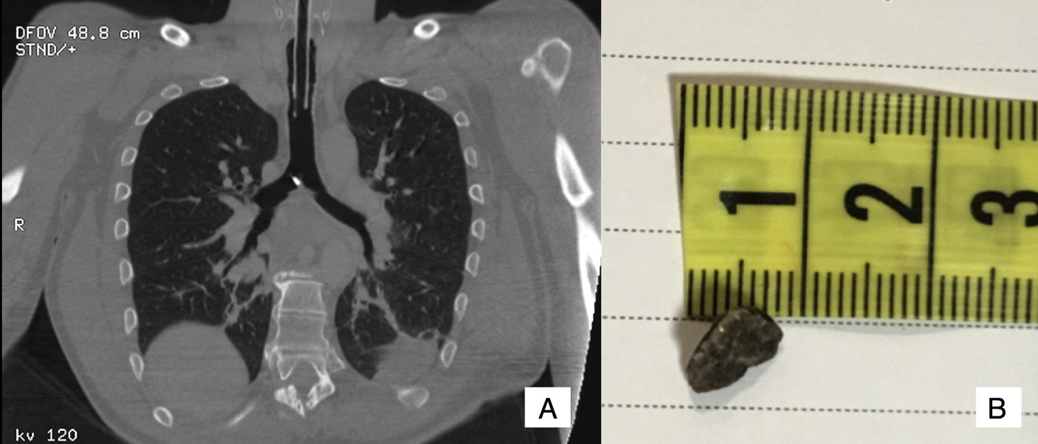 An Unusual Case of Bronchoaspiration of a Foreign Body in a ...