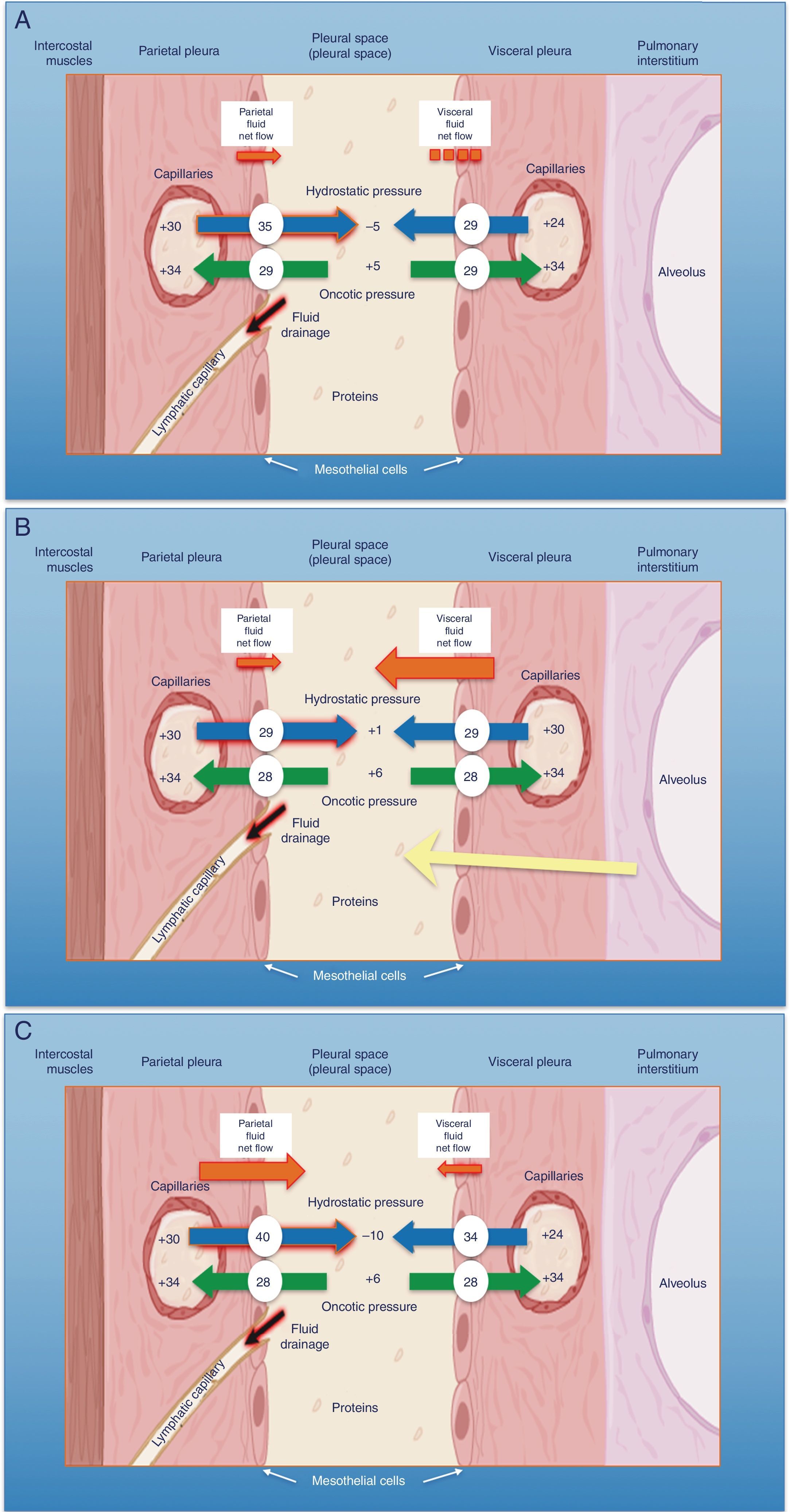 bilateral pleural effusion causes