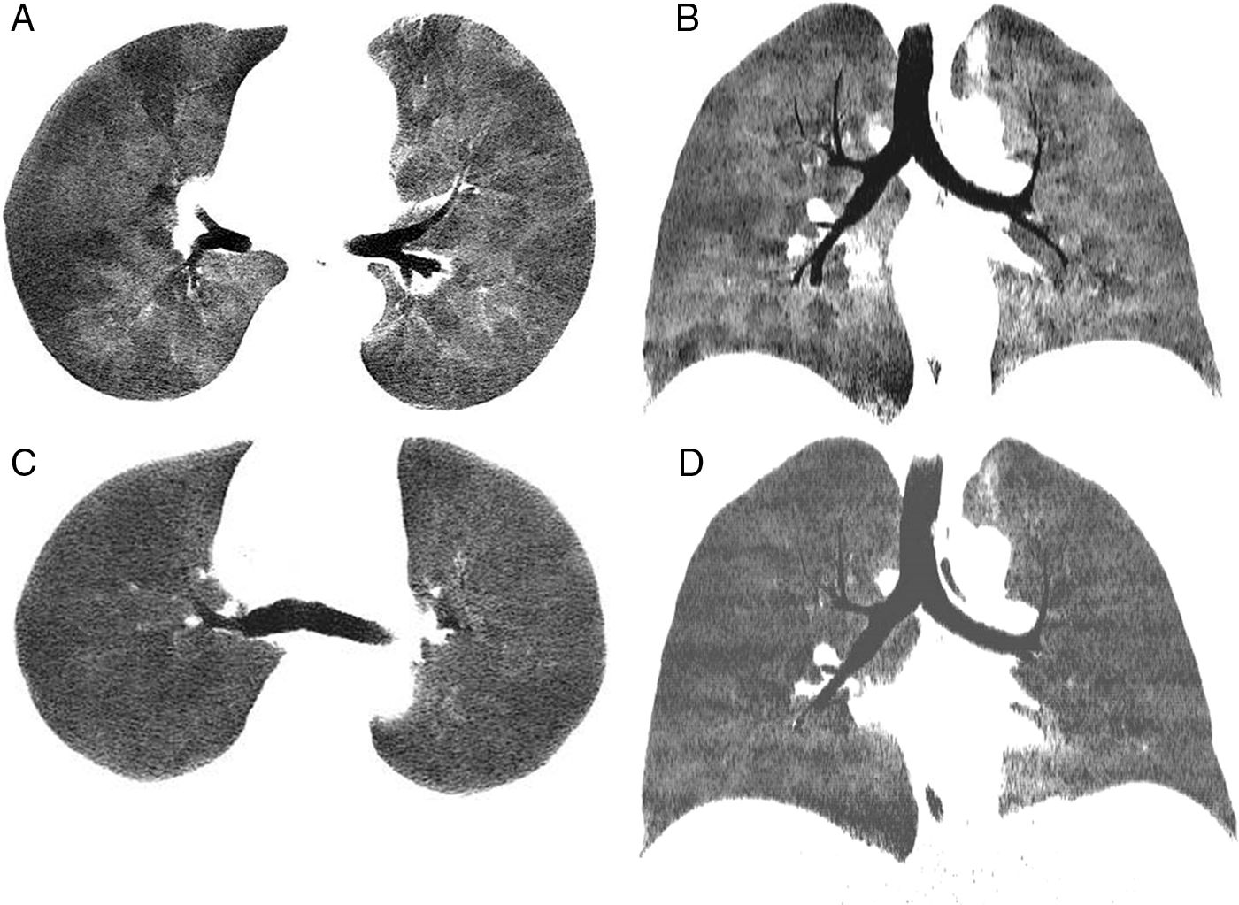 Radiological Improvement of Bronchiolitis Obliterans Following ...