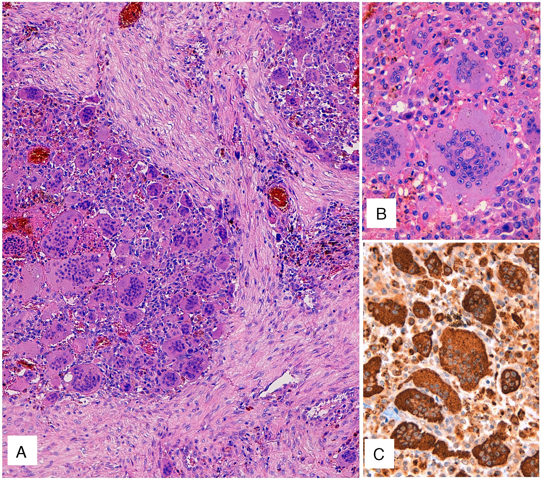 multinucleated giant cells