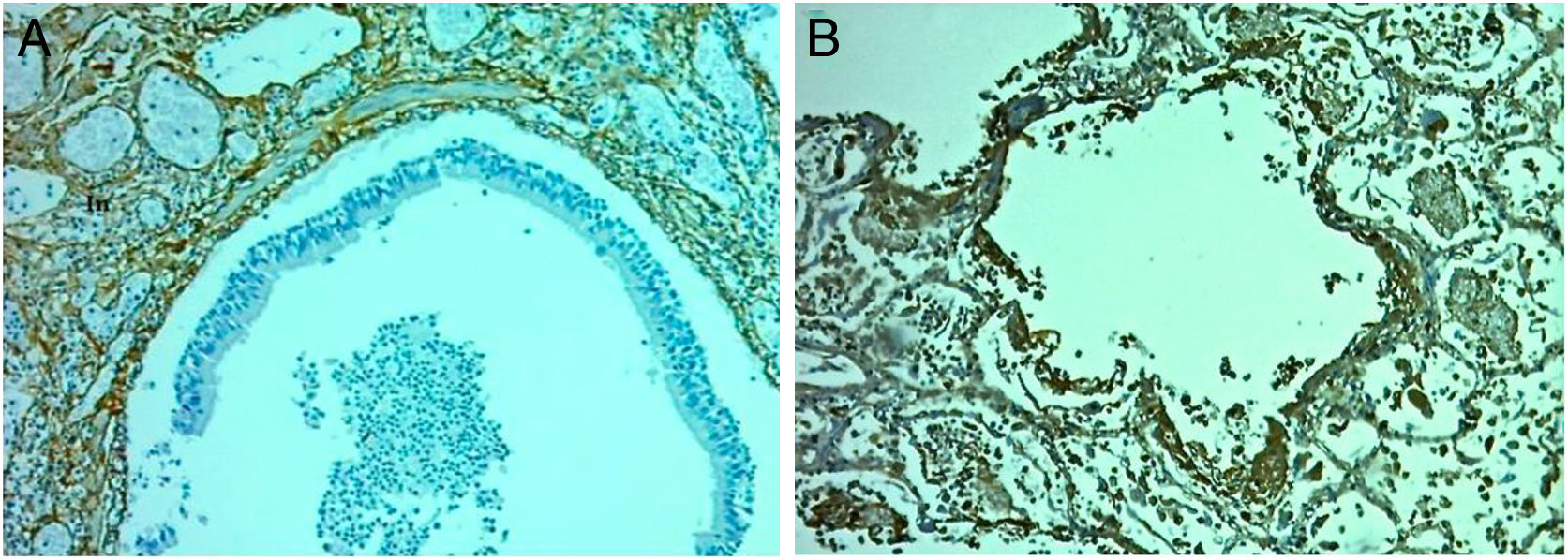 Airway Pathological Alterations Selectively Associated With Acute ...