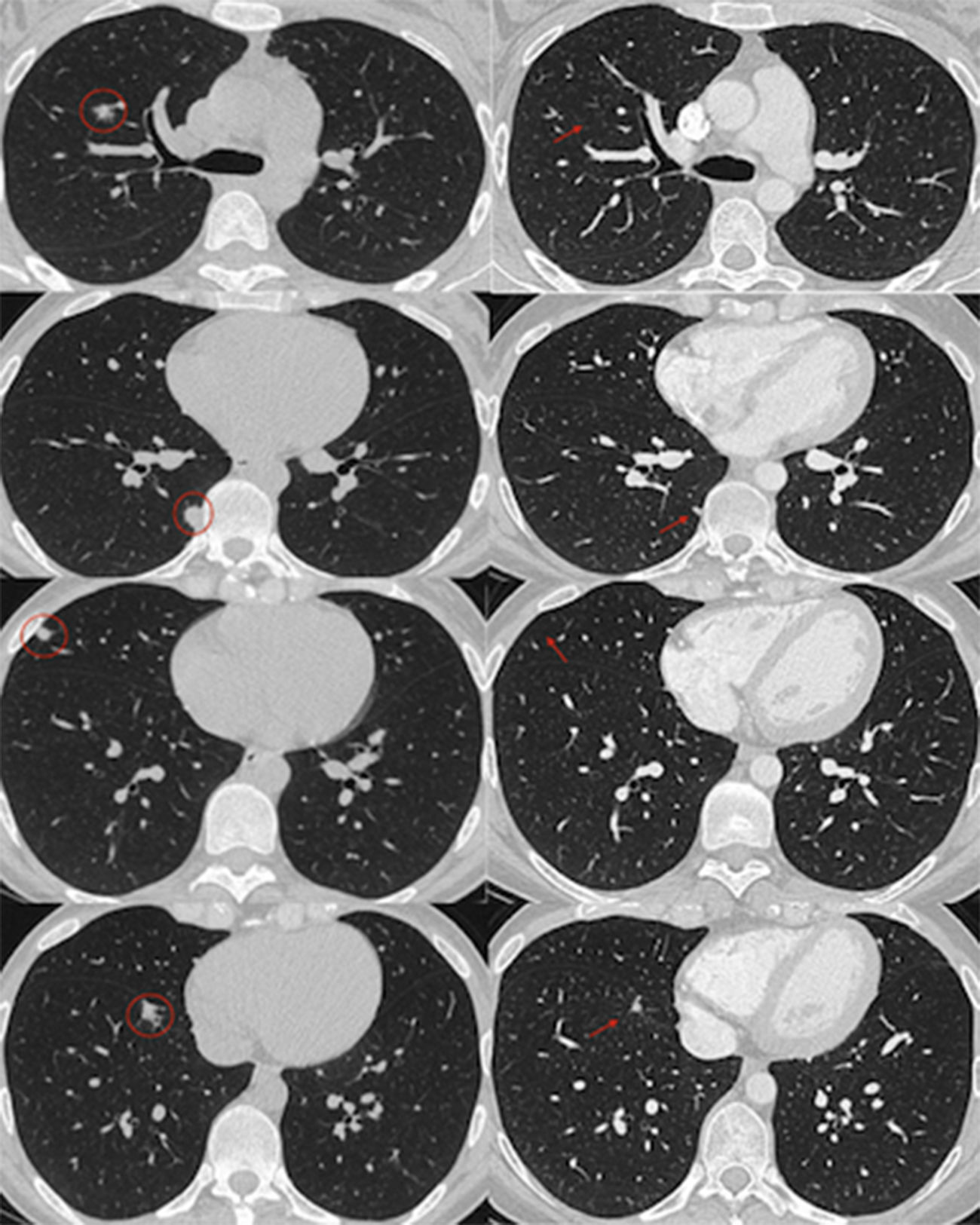 Pulmonary Necrobiotic Nodules: A Rare Manifestation of Crohn's Disease ...