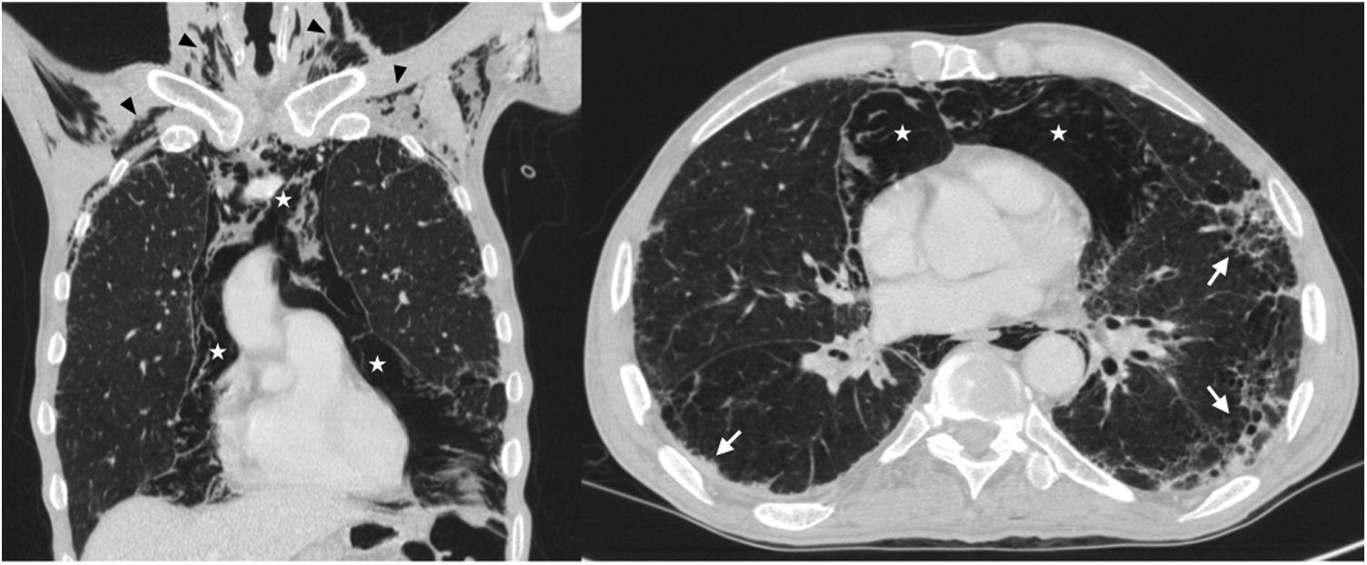 dermatomyositis chest ct