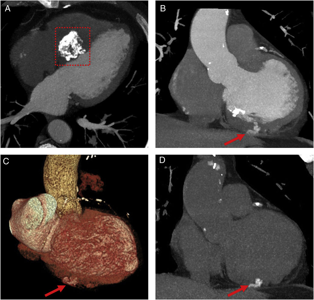 ventricular lesion