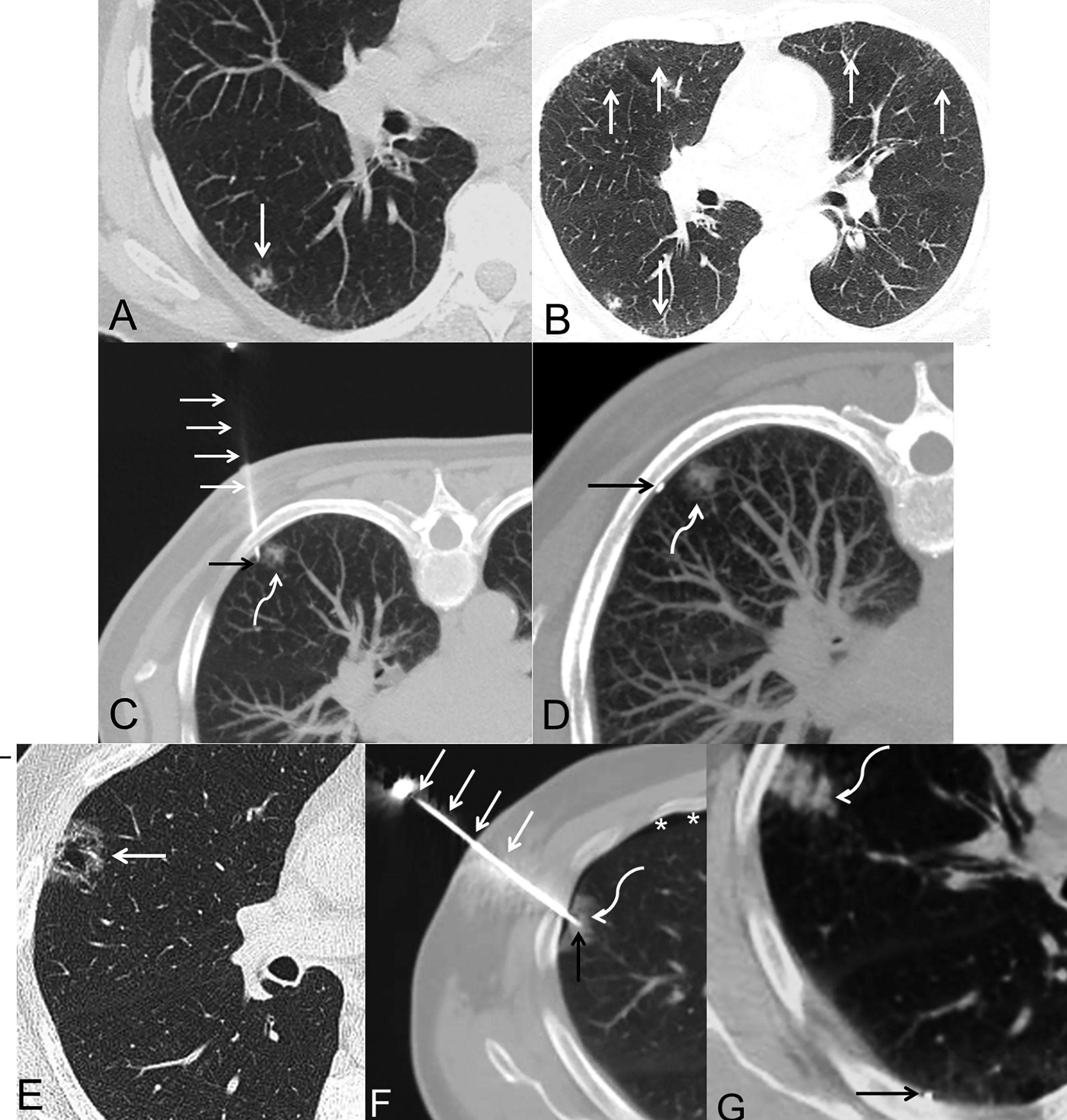 “Pole-tent” effect: an unreported complication of percutaneous marking ...
