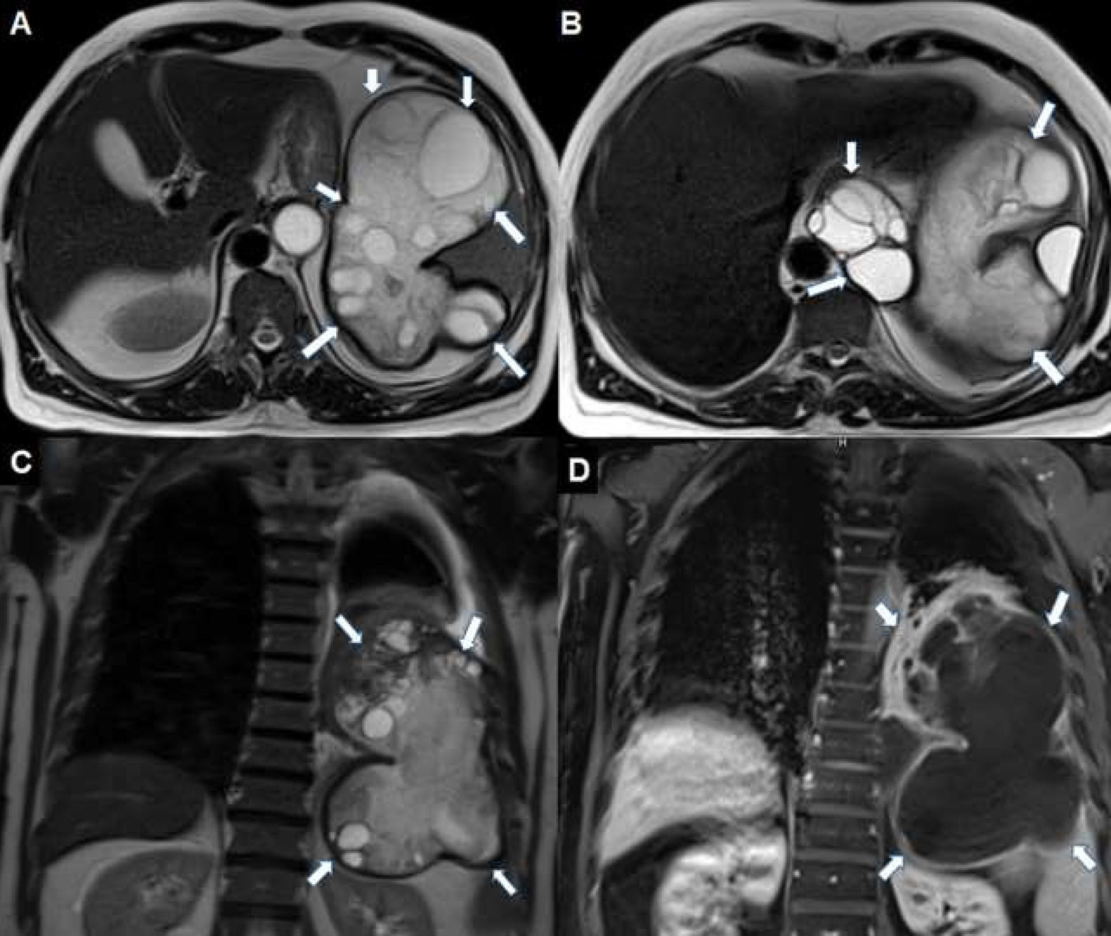 A Rare Cause of Lung and Splenic Compression: Primary Giant ...