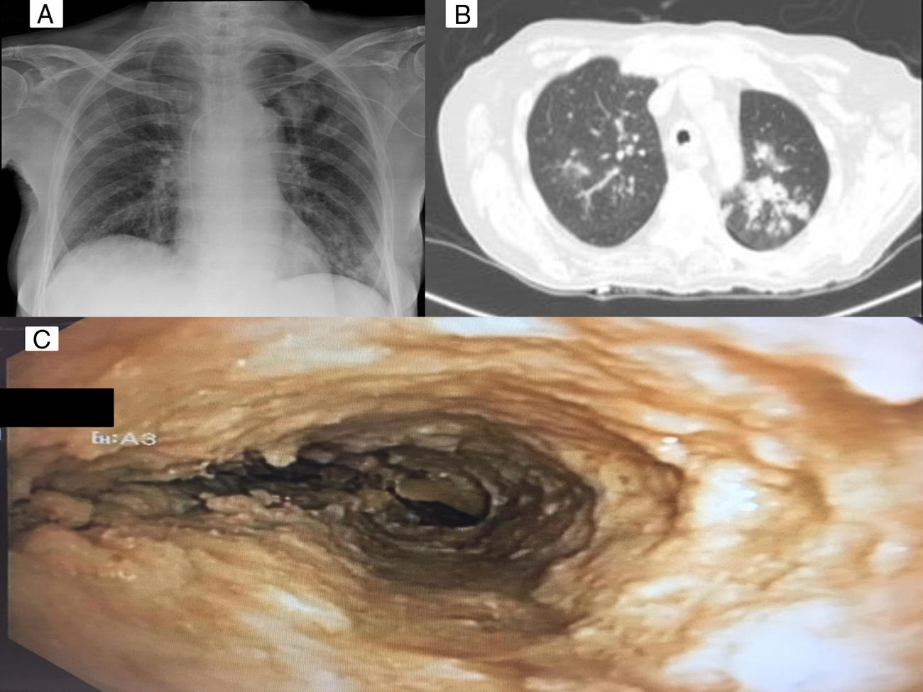 Aspergillus tracheobronchitis: The diagnostic value of endoscopic ...