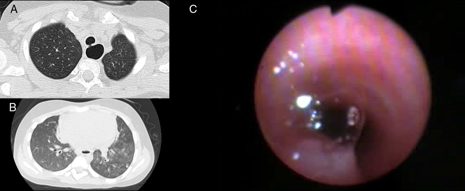 bronchoscopy pneumonia