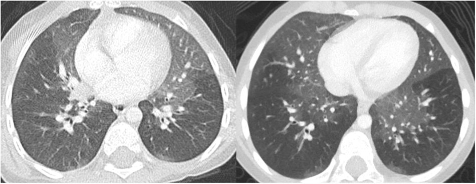 lingula lung ct