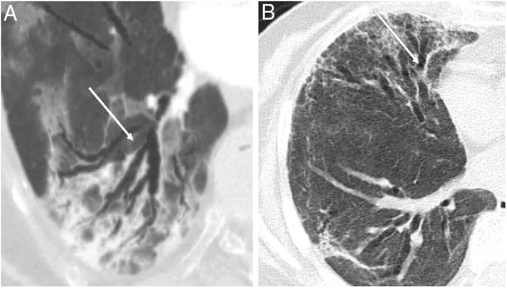 pleurisy bronchiectasis