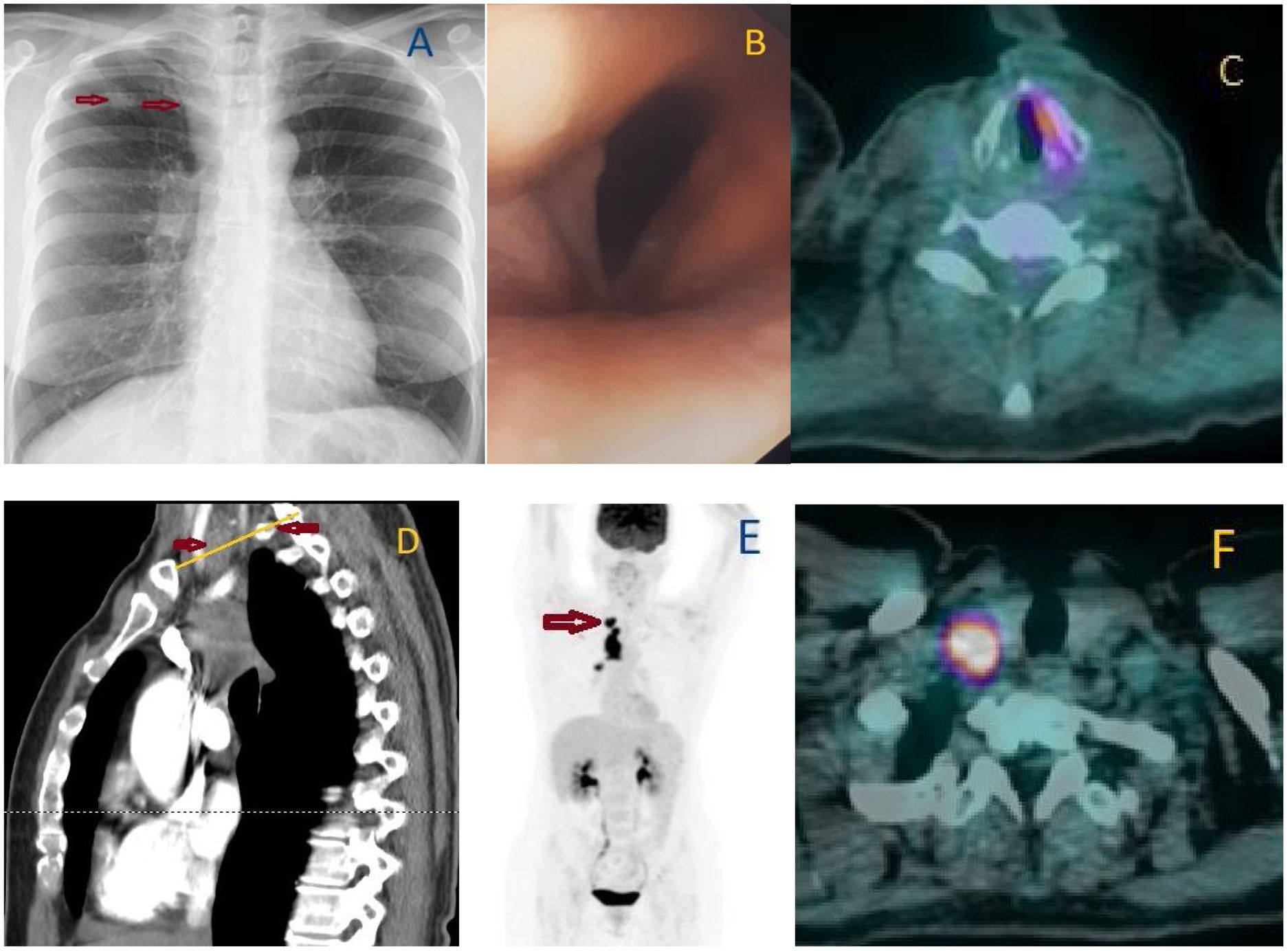 Right Vocal Cord Paralysis Due to Lymphatic Spread of Lung Cancer ...