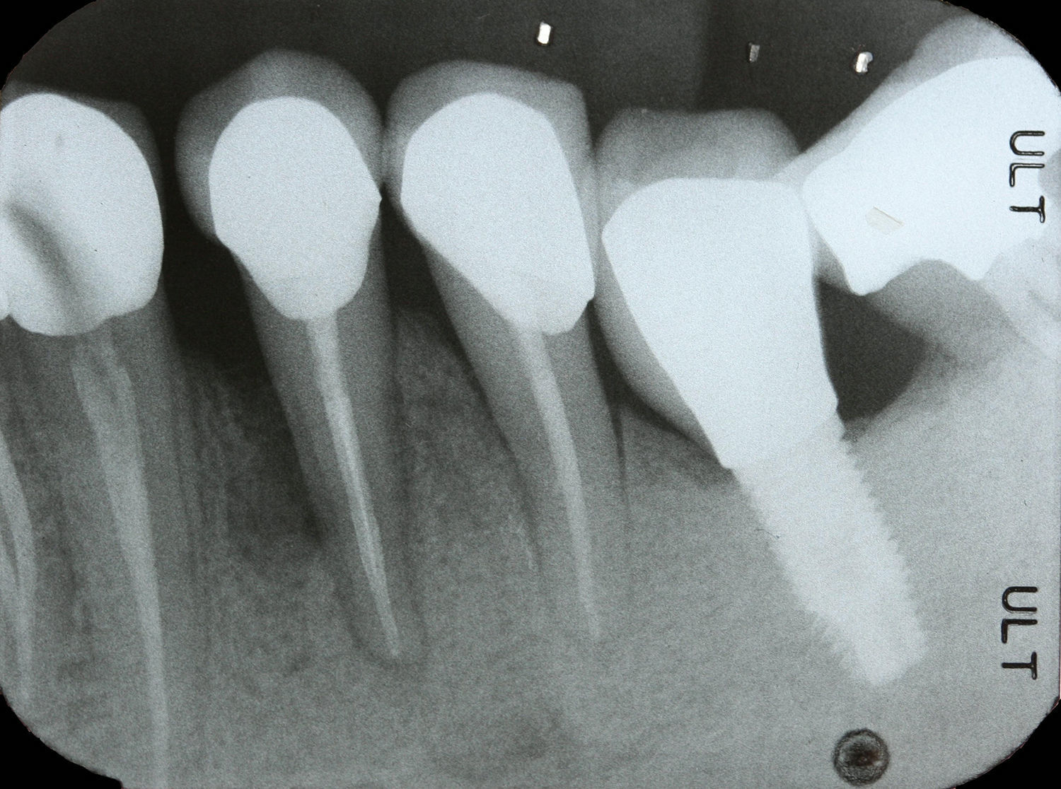 Vertical root fracture diagnosis of crowned premolars with root canal ...