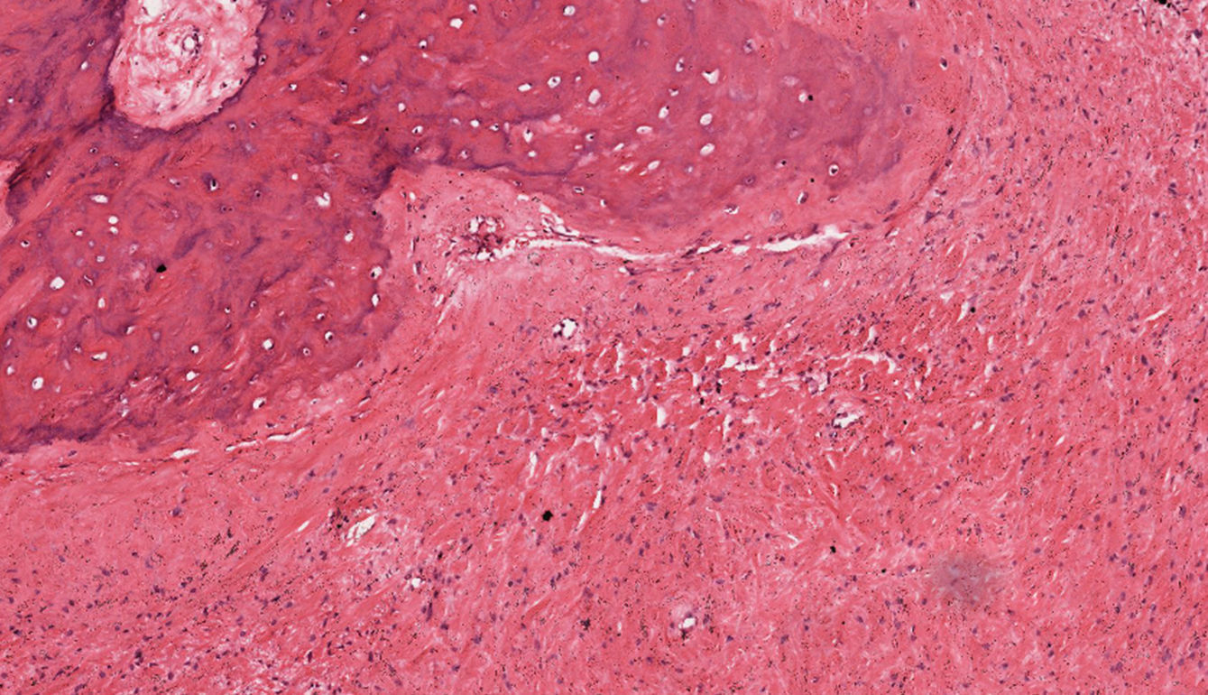 Focal osteoporotic bone marrow defect with unusual presentation ...