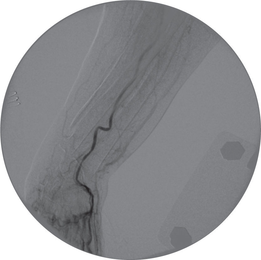 Acute critical hand ischemia secondary to iatrogenic intrarterial ...