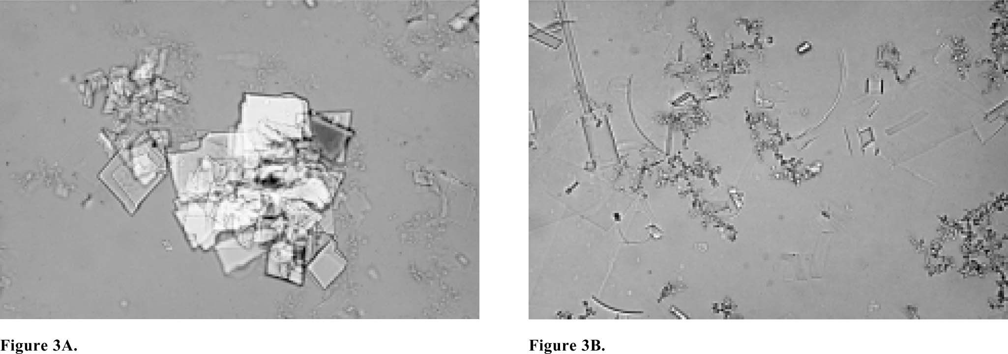 microlithiasis gallbladder symptoms