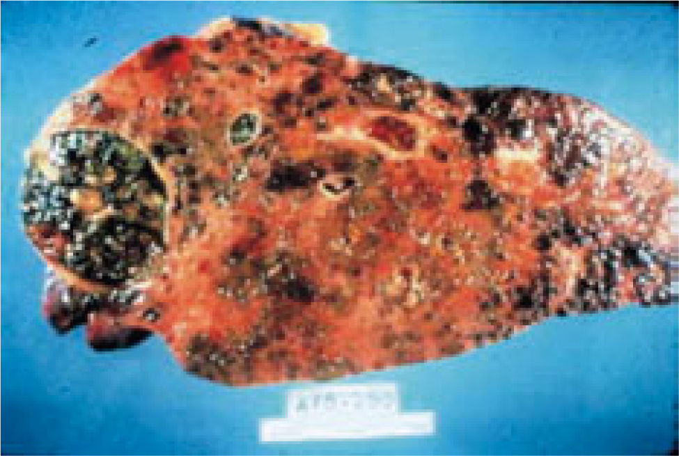 hepatic adenoma gross specimen