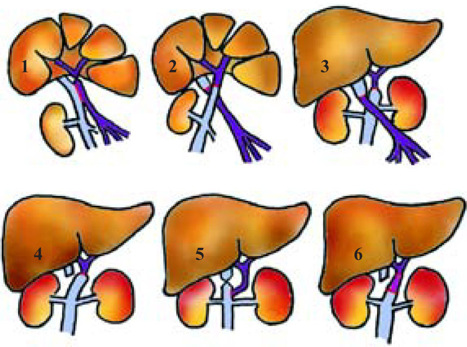 Cavoportal hemitransposition for the simultaneous thrombosis of the ...