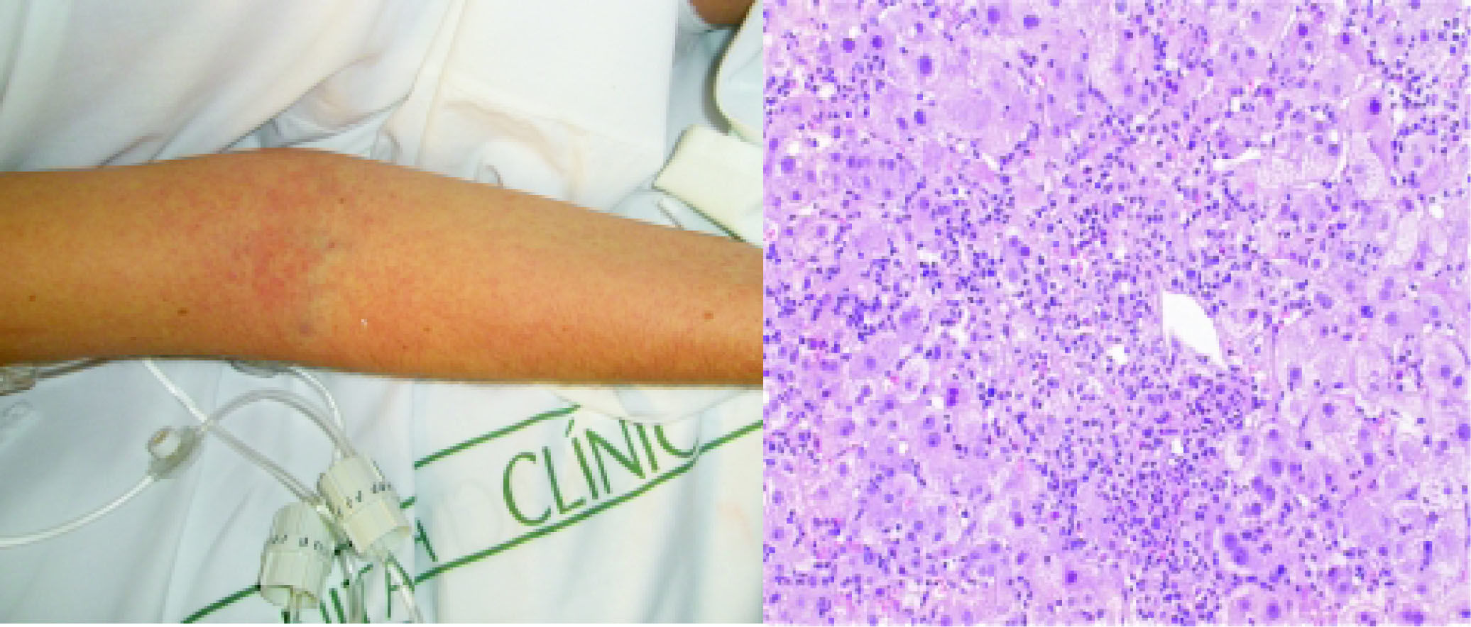Severe acute hepatitis in the dress syndrome: Report of two cases ...