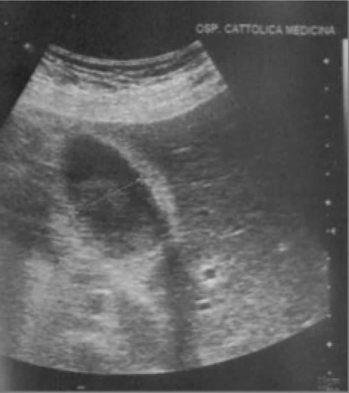 Uncommon localization of amyloidosis in gallbladder: Description of a ...