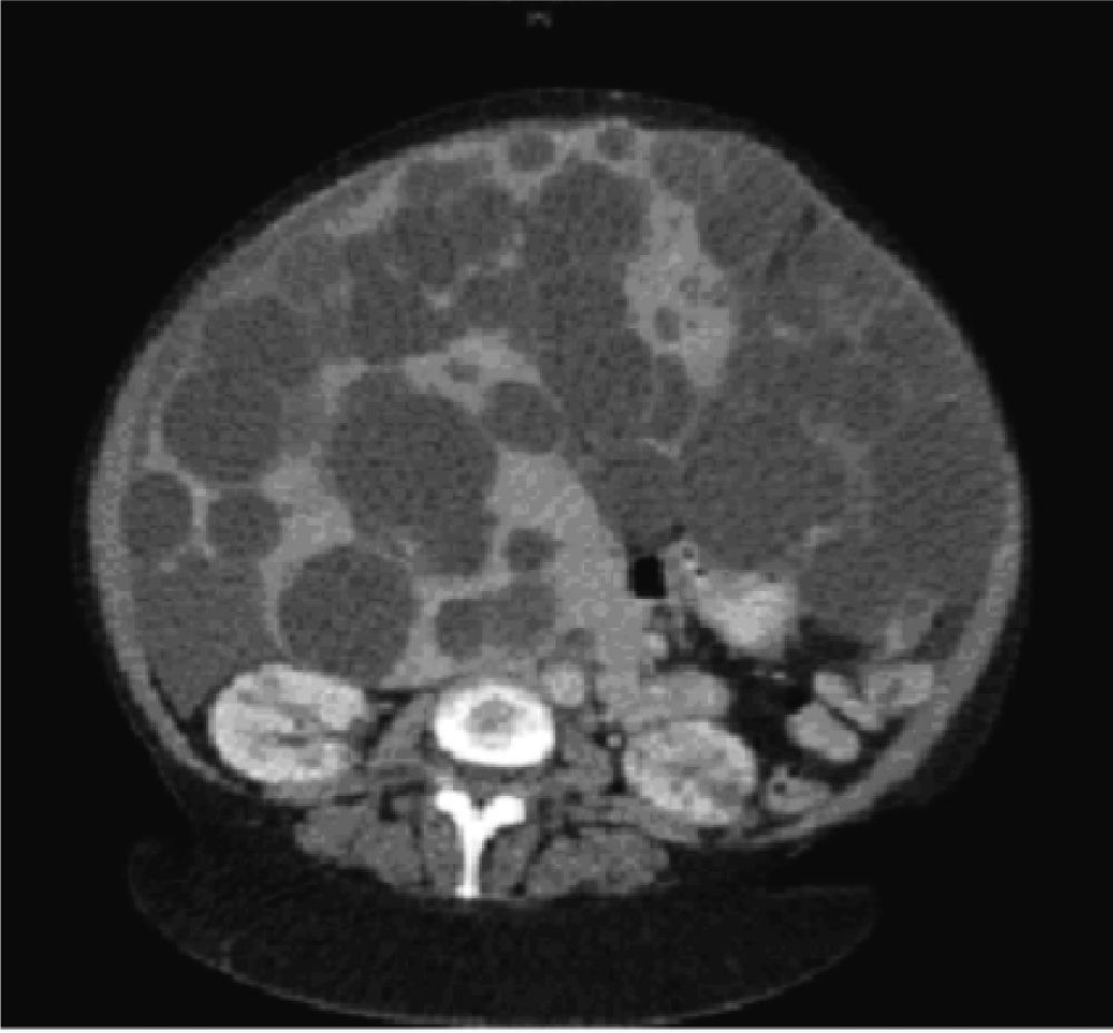 Polycystic liver disease: a clinical review | Annals of Hepatology