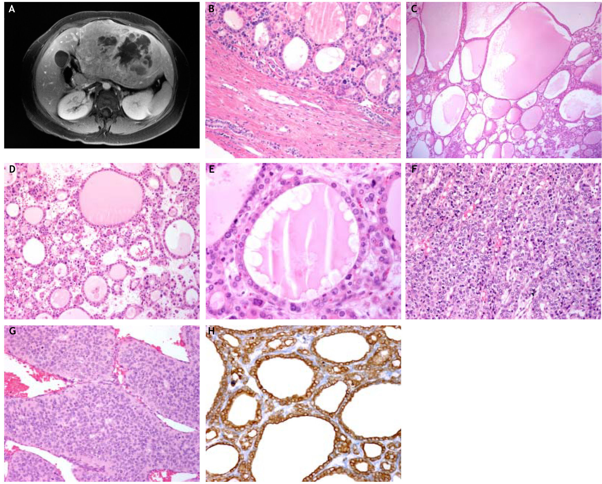 Thyroid-like cholangiocarcinoma of the liver: an unusual morphologic ...
