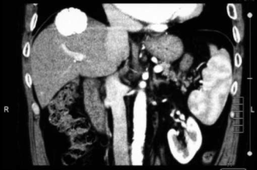 A giant calcified hepatic mass | Annals of Hepatology