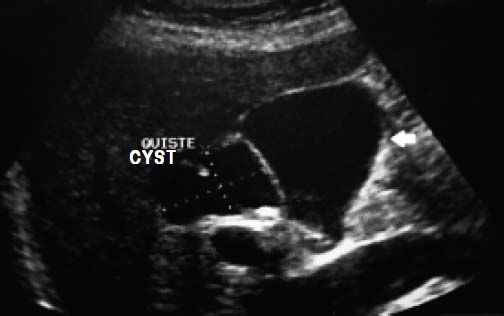An unusual type of biliar cyst: A case report | Annals of Hepatology